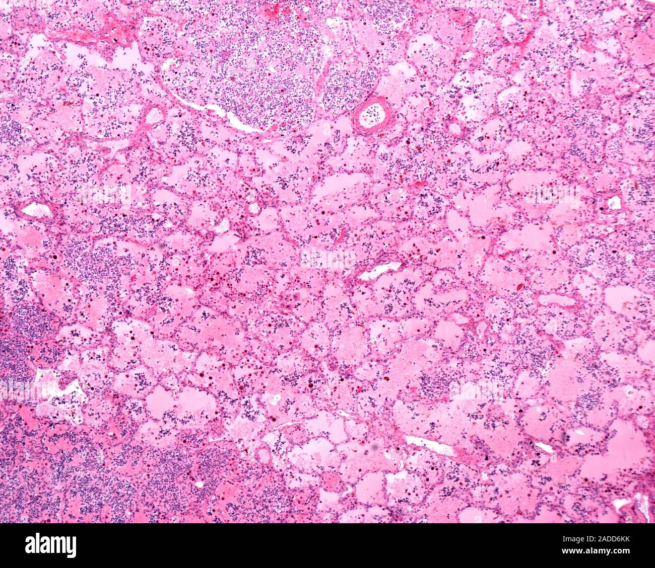 Low magnification light micrograph of a human lung affected by an acute ...
