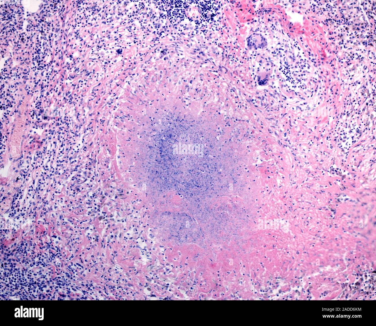 Light micrograph of a typical granuloma (inflamed nodule) in a human ...