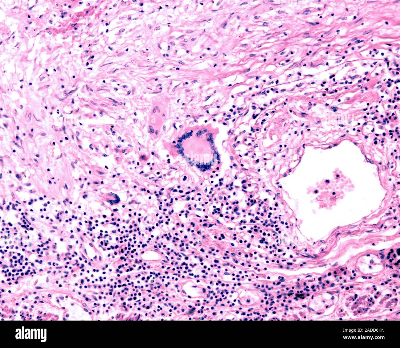 Light micrograph of a Langhans-type giant cell in the periphery of a ...