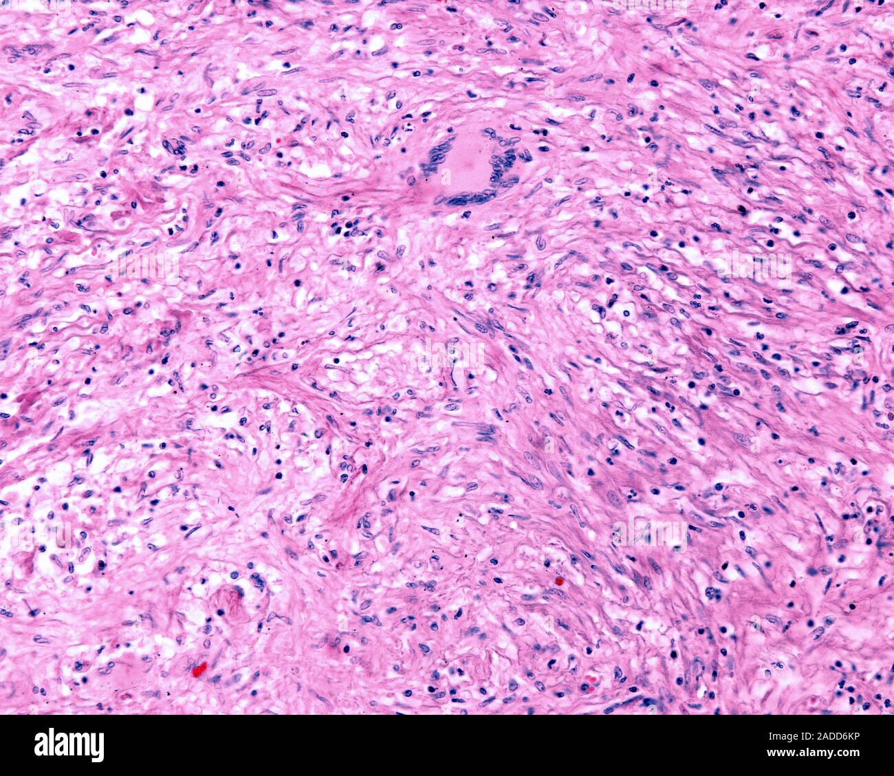 Light micrograph of a Langhans-type giant cell located in the fibrotic ...
