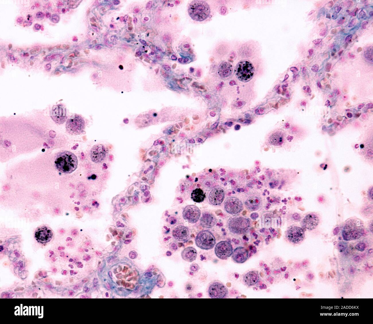 Light micrograph of alveolar macrophages and polymorphonuclear ...
