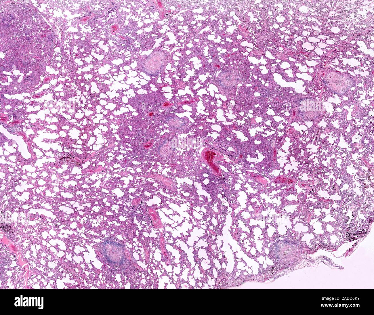 Very low magnification light micrograph of a human lung in a case of ...