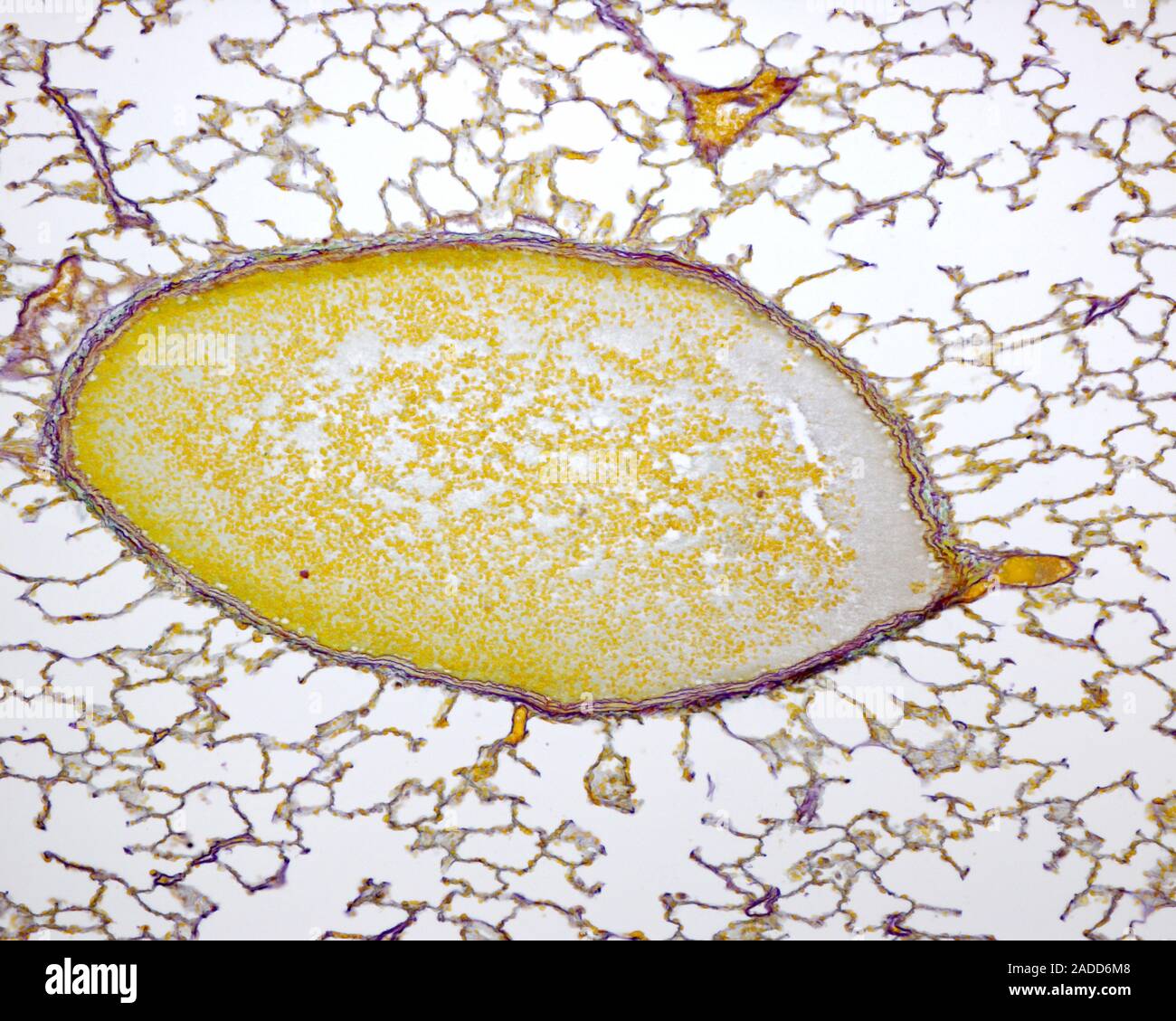 Light micrograph of a large pulmonary vein surrounded by dilated ...