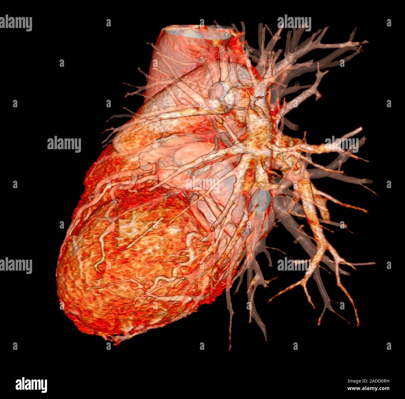 Human heart, 3D coloured computed tomography (CT) angiogram. This is a left-side view, showing ...