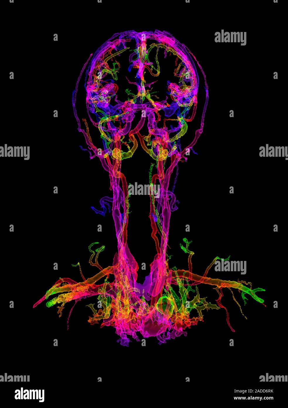Head and neck blood vessels, 3D computed tomography (CT) angiogram. This is a frontal view ...