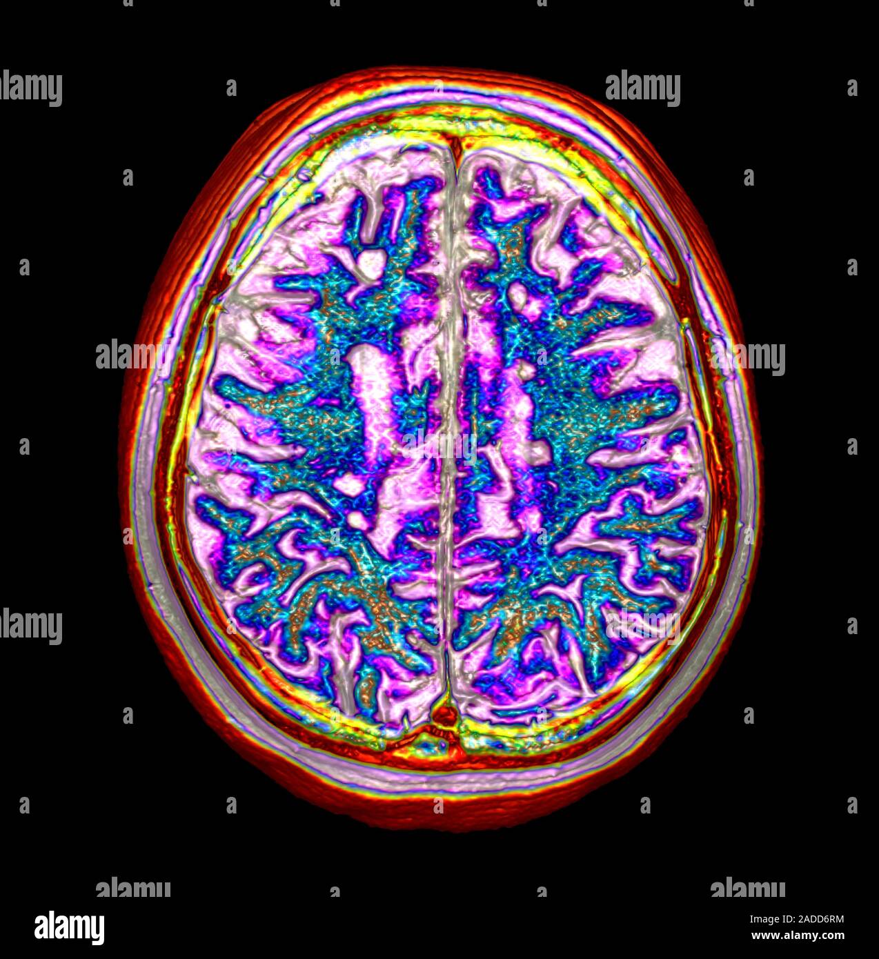 Multiple sclerosis. Coloured axial magnetic resonance imaging (MRI) scan through the upper ...