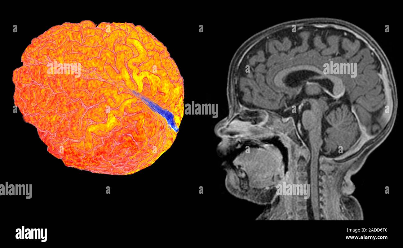Child's brain and head. Coloured 3D magnetic resonance imaging (MRI) scan of a child's brain ...