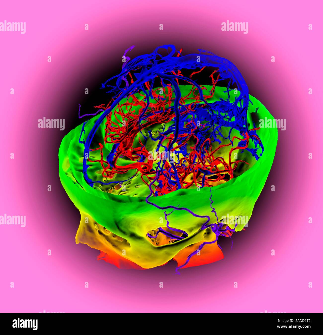 Brain blood vessels. Coloured 3D computed tomography (CT) angiogram, showing the arteries (red ...
