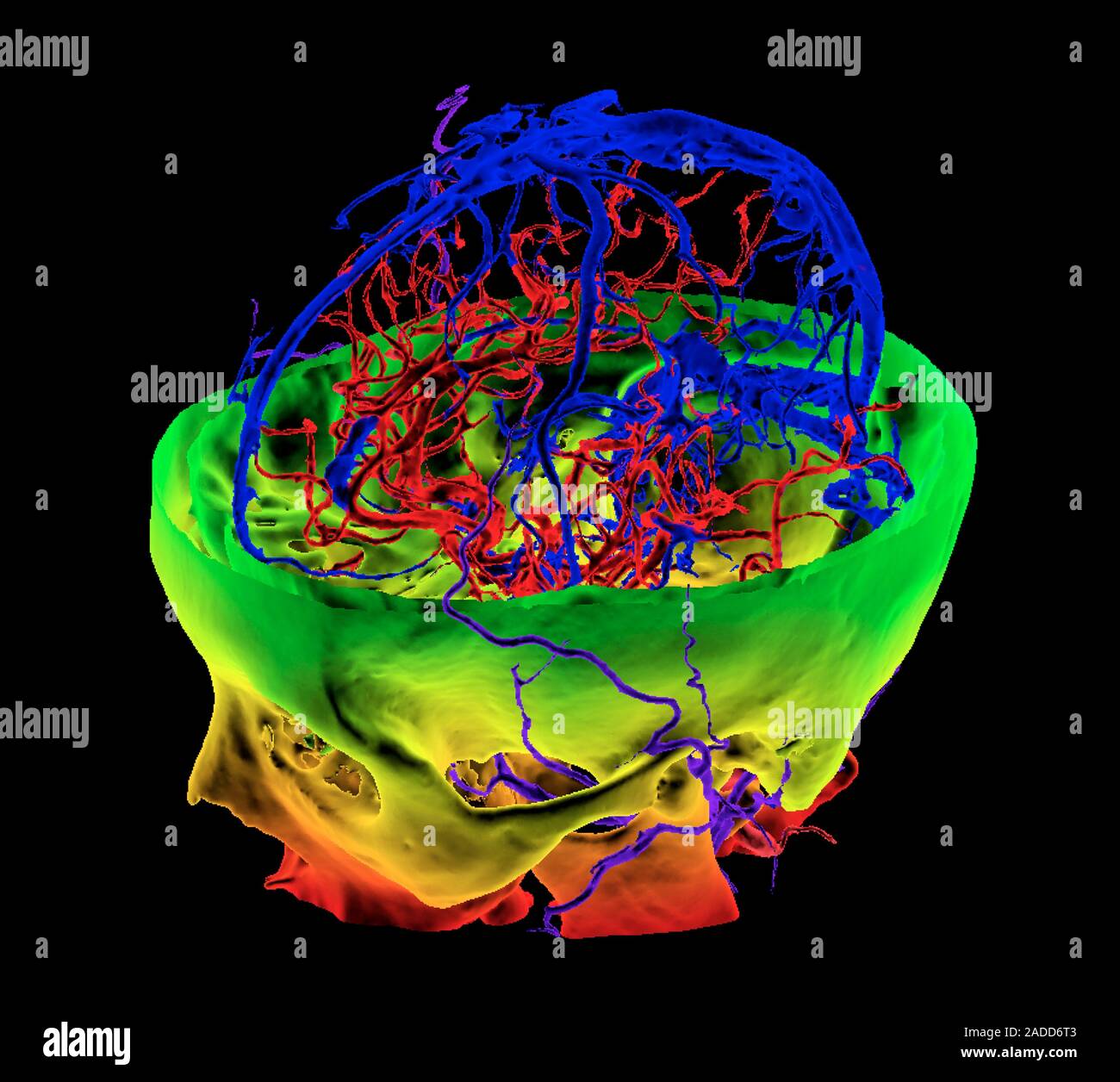 Brain blood vessels. Coloured 3D computed tomography (CT) angiogram, showing the arteries (red ...