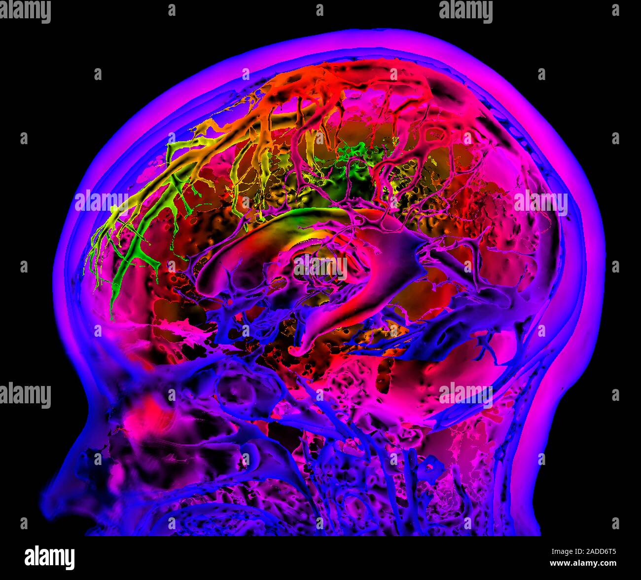 Brain ventricles and veins. Coloured 3D magnetic resonance imaging (MRI) and computed tomography ...