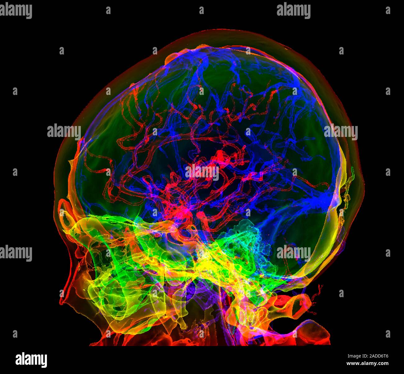 Brain blood vessels. Coloured 3D computed tomography (CT) angiogram, showing the arteries (red ...