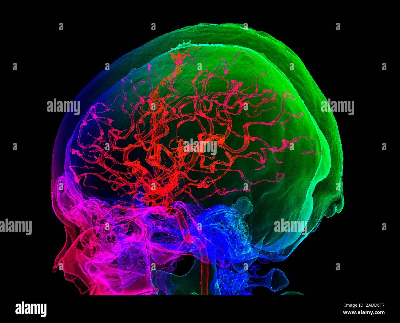 Brain blood vessels. Coloured 3D computed tomography (CT) angiogram, showing the arteries (red ...