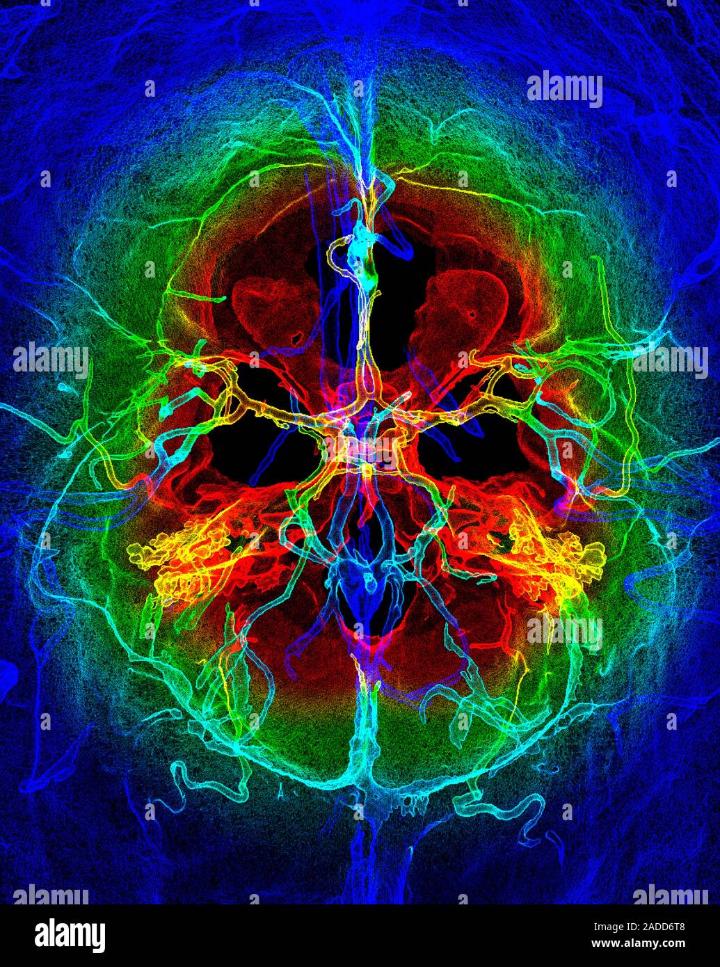 Intracranial arteries. 3D computed tomography (CT) scan of a human ...
