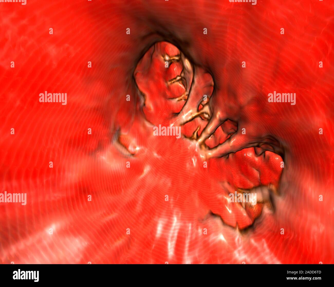 Left atrial appendage closure. Coloured 3D computed tomography (CT ...
