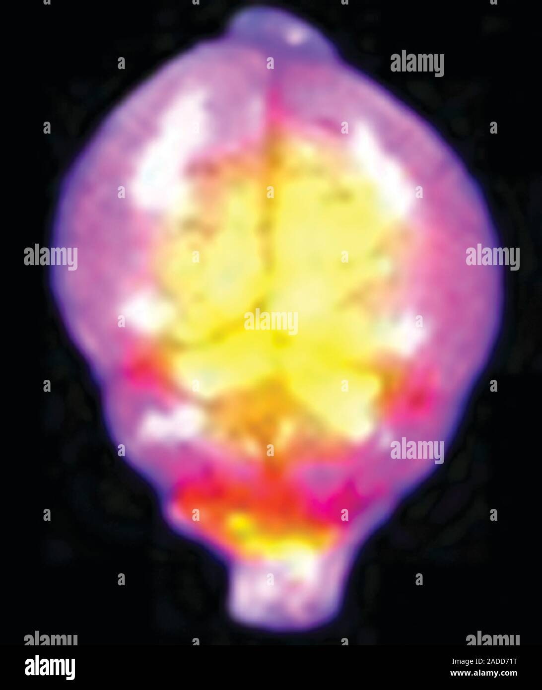 Nanoparticles as experimental brain cancer treatment. Spherical nucleic ...