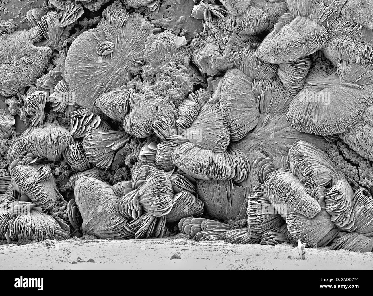 Kidney stone surface, scanning electron micrograph (SEM). Kidney stones ...