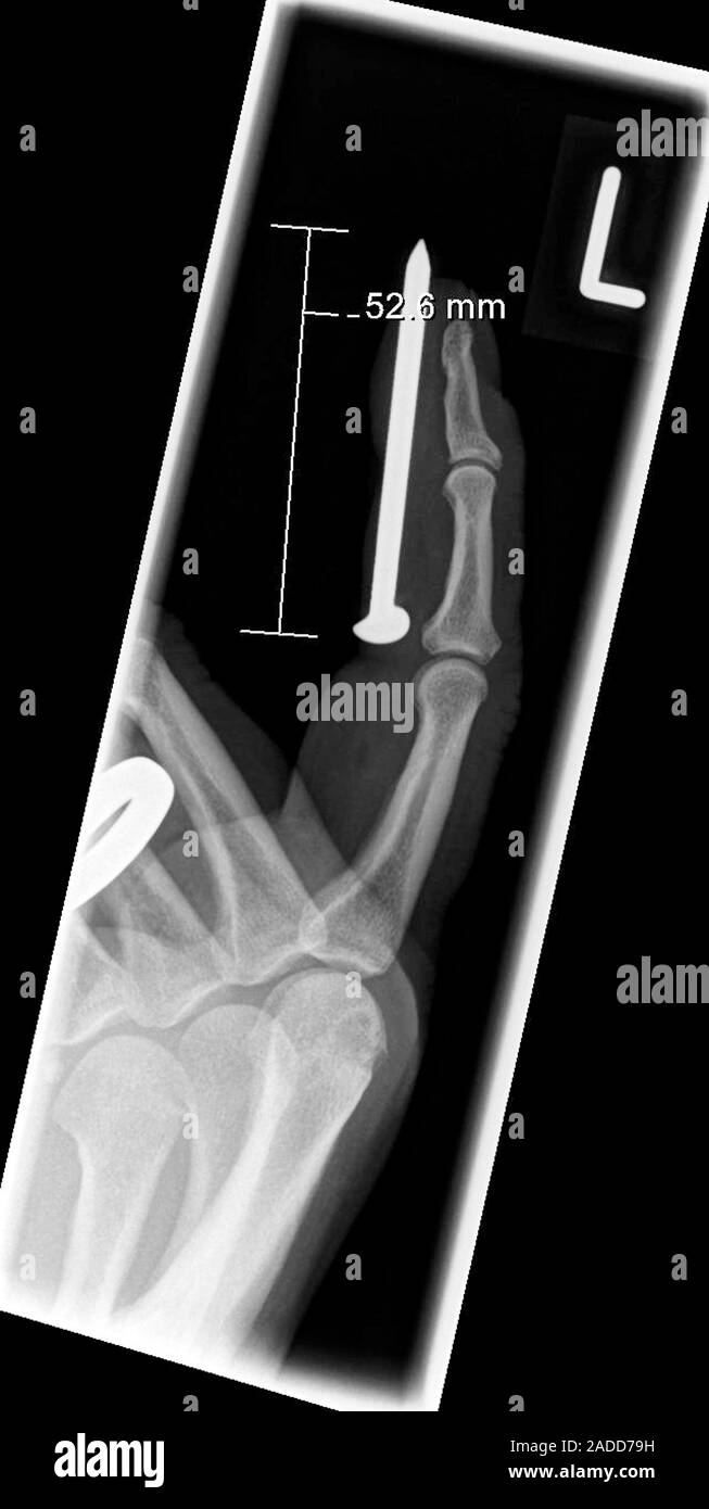 Nail injury to index finger, X-ray. The labels indicate that this is ...