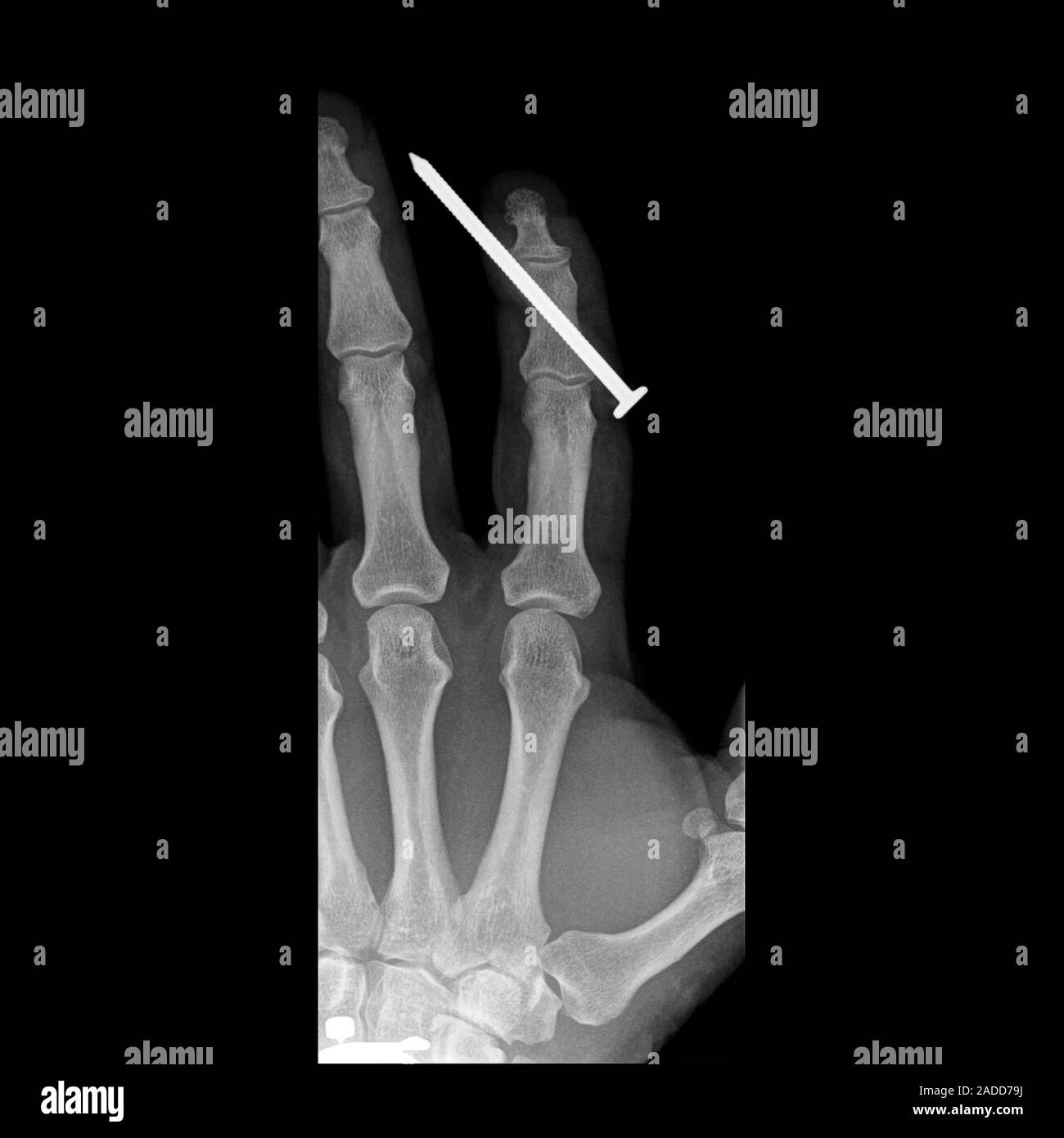 Nail injury to index finger, X-ray. For the same injury with labels ...
