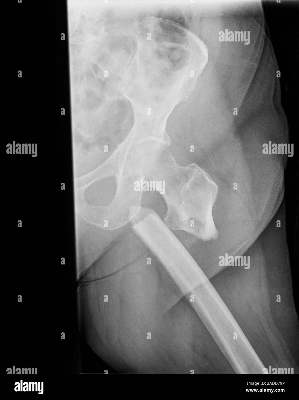 Fractured femur. X-ray of a patient's left hip, showing a fracture of ...