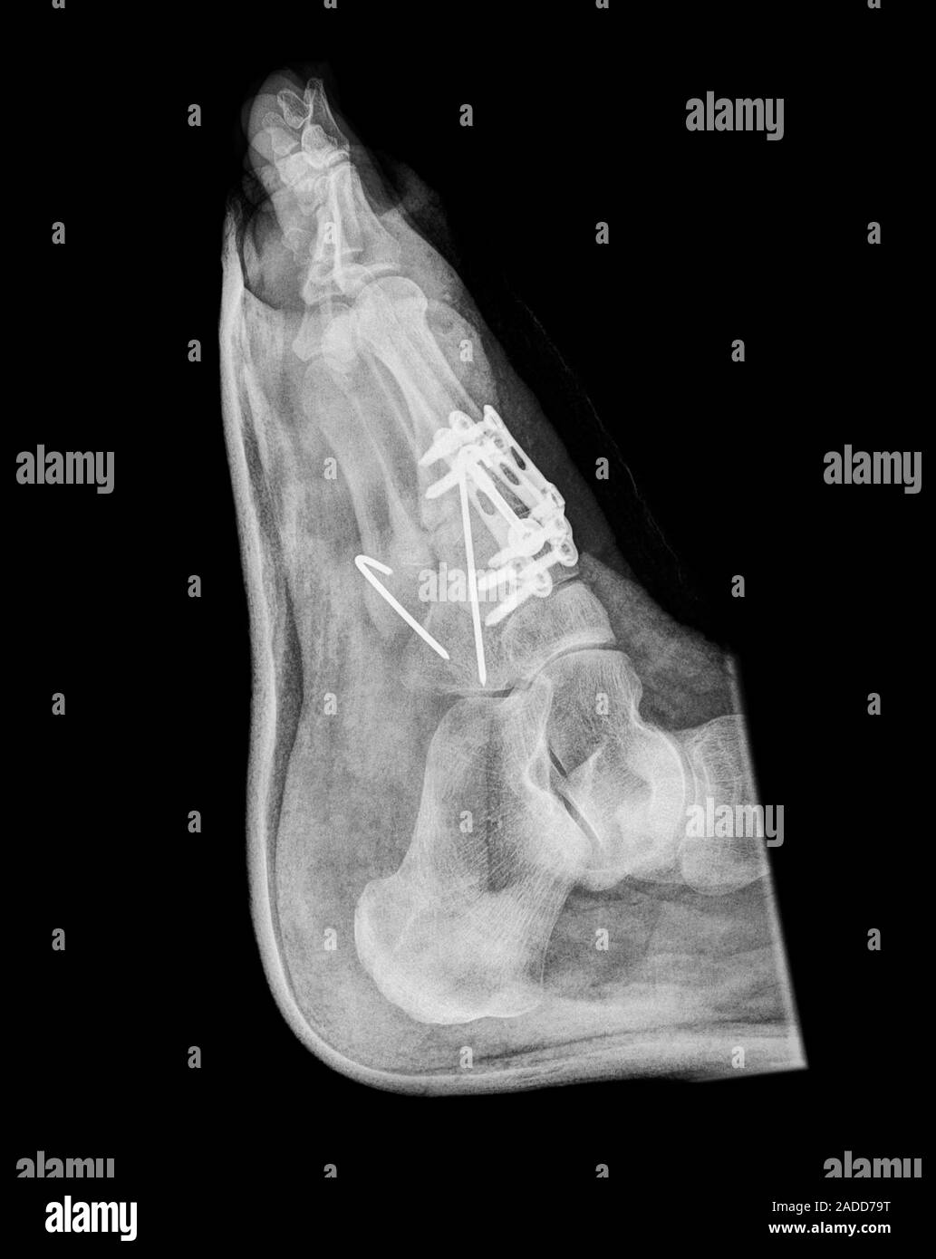 Pinned Fractured Metatarsal Foot Bones X Ray The Metatarsals Are The Bones Between The Toes