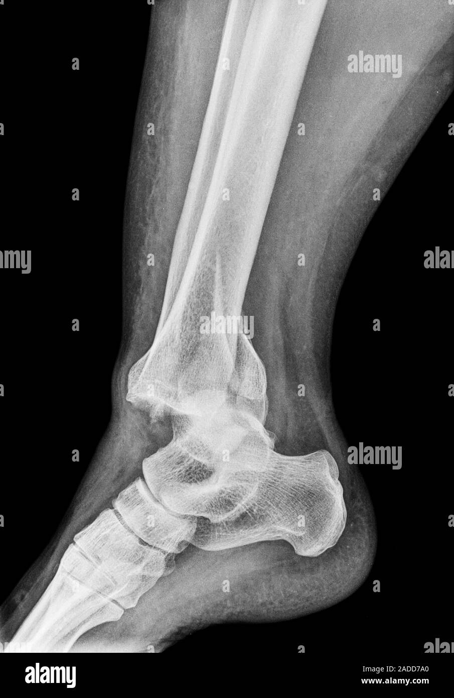 Fractured Ankle Bones X Ray The Fracture Is At Lower Left For The