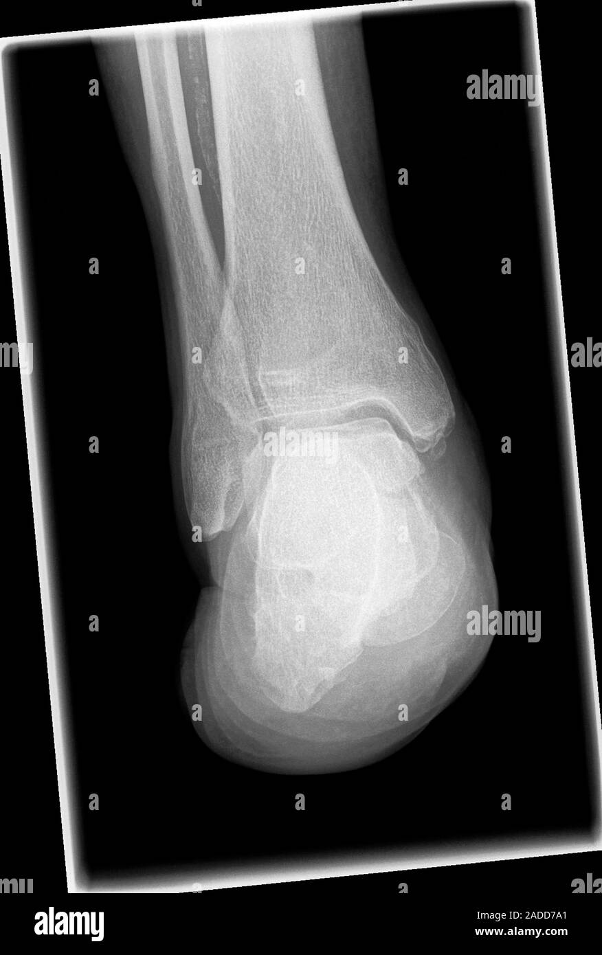 Foot amputation, X-ray. The forefoot has been amputated, leaving the ...