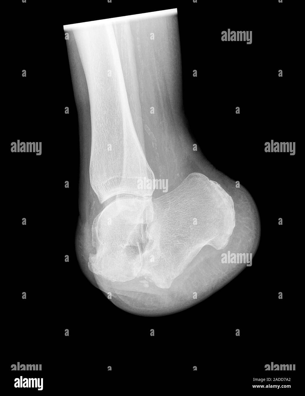 Foot amputation, X-ray. The forefoot has been amputated, leaving the ...