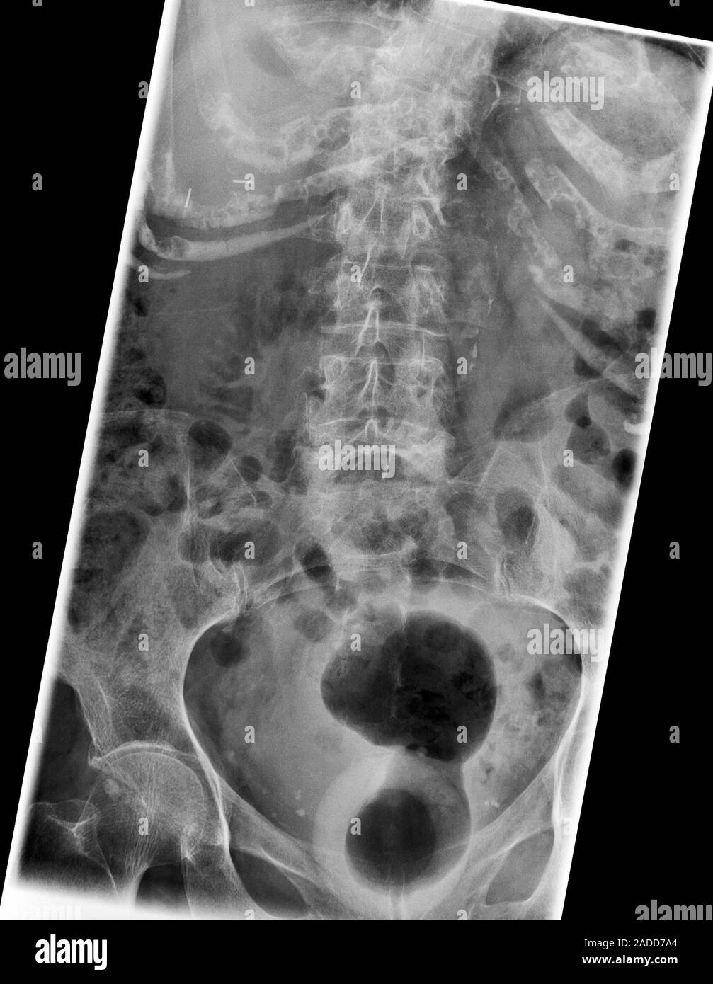 Lumbar vertebral collapse. X-ray of a patient's lumbar spine, showing ...
