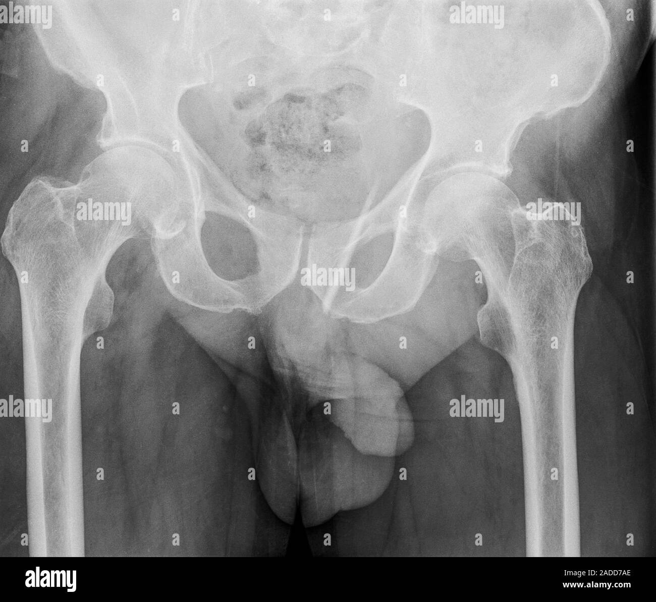 Glass shard in buttocks. X-ray of a sharp foreign body (glass shard ...