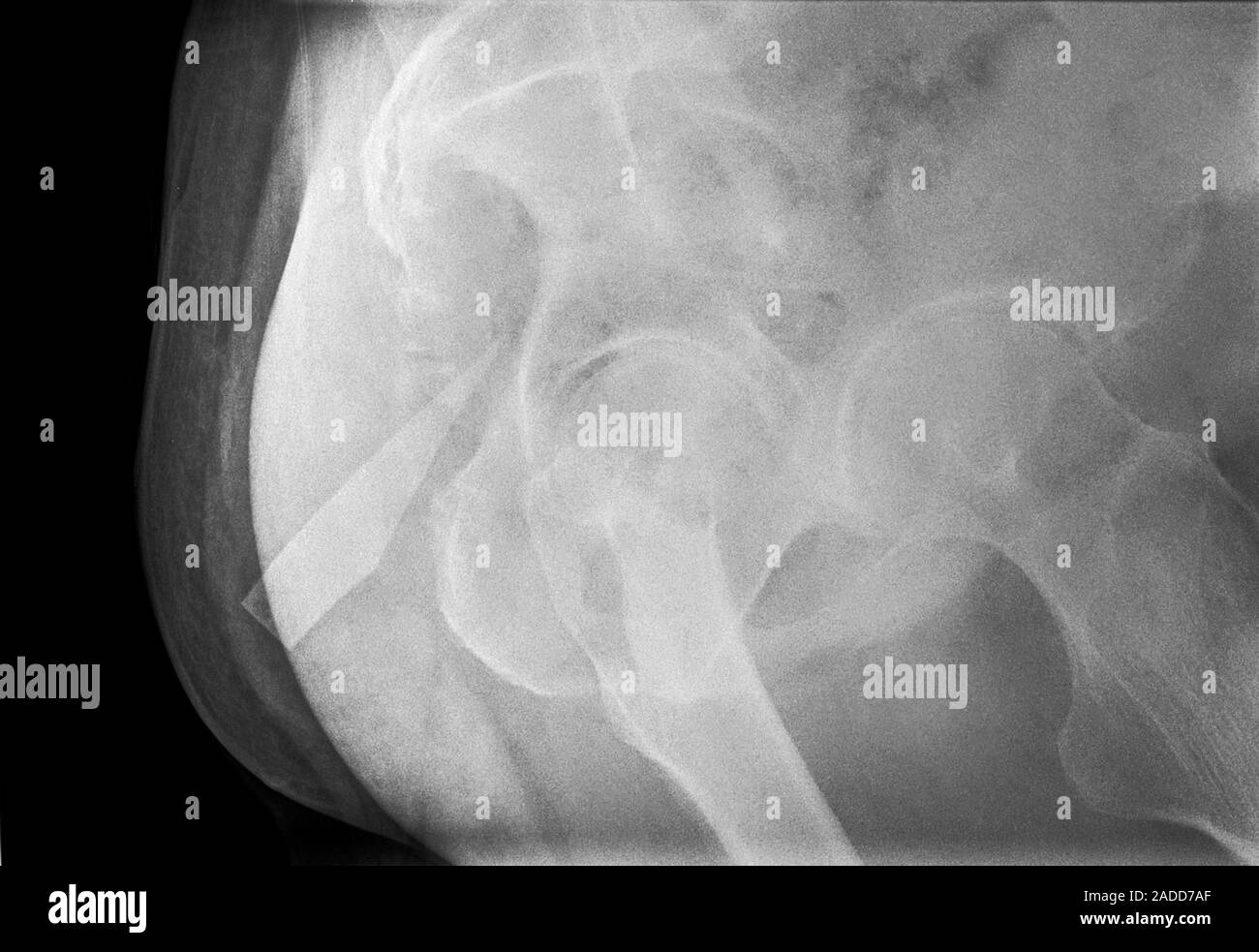 Glass shard in buttocks. X-ray of a sharp foreign body (glass shard ...