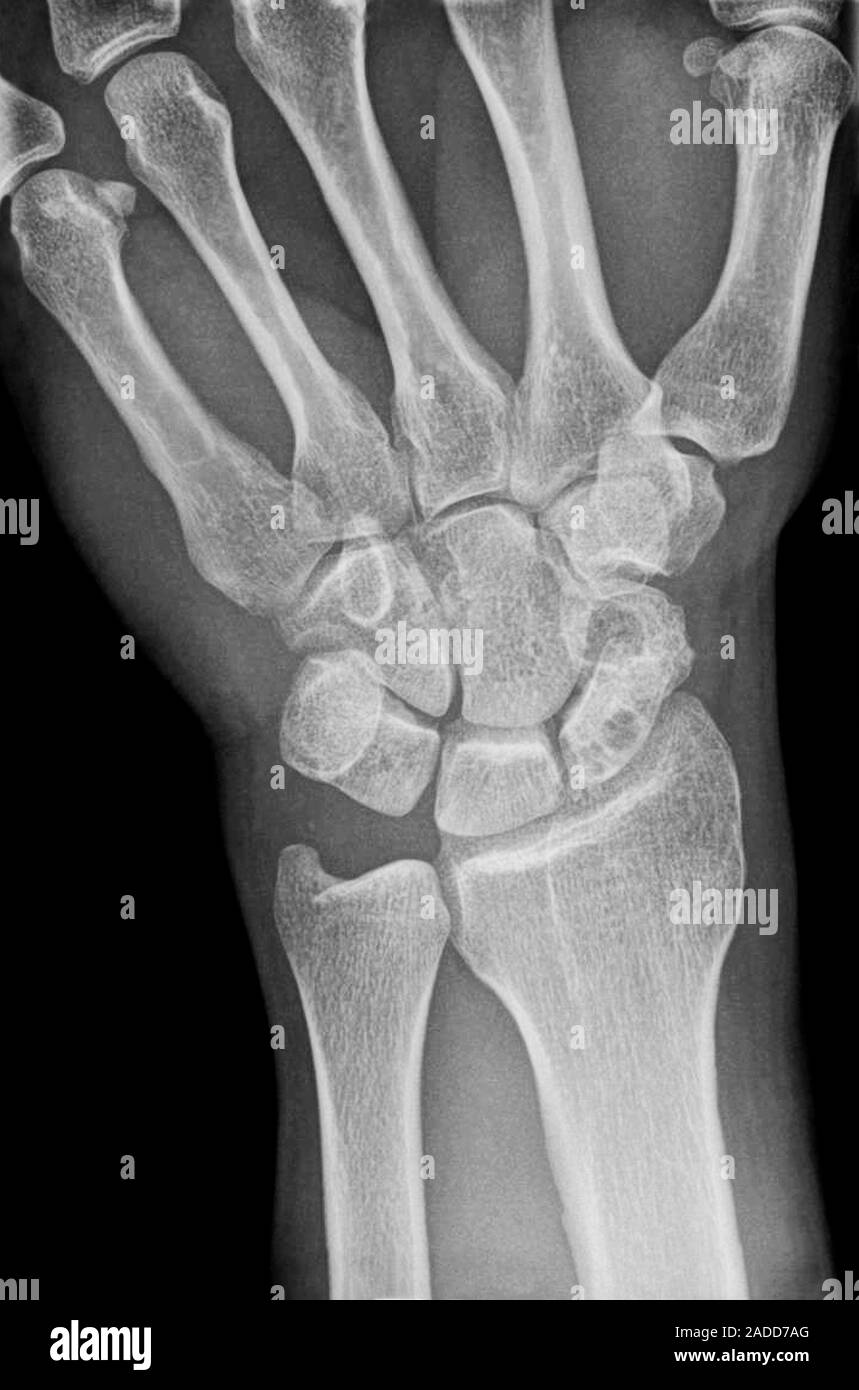 Fractured scaphoid wrist bone with subchondral cysts, X-ray. The ...