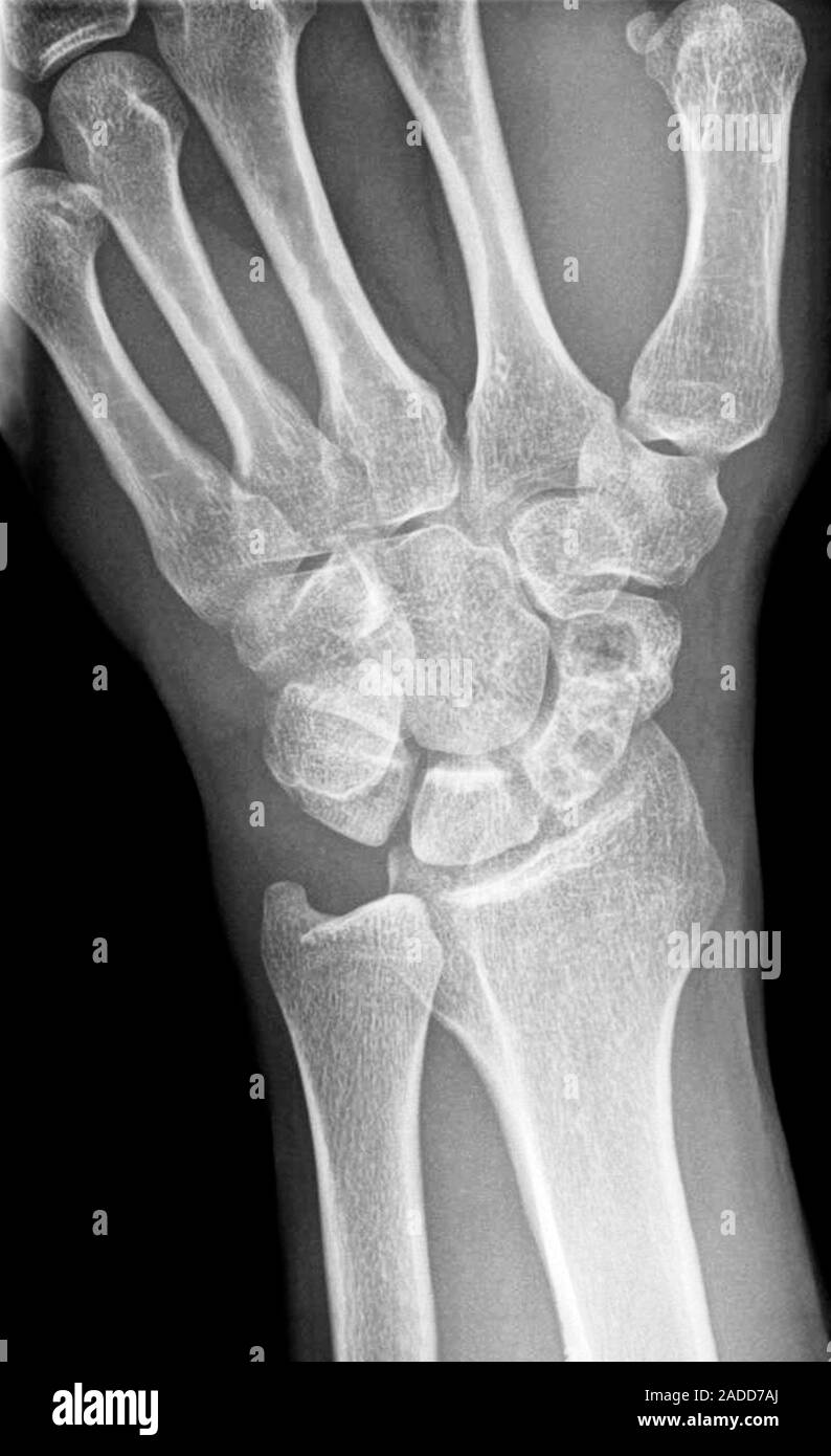 Fractured scaphoid wrist bone with subchondral cysts, X-ray. The ...