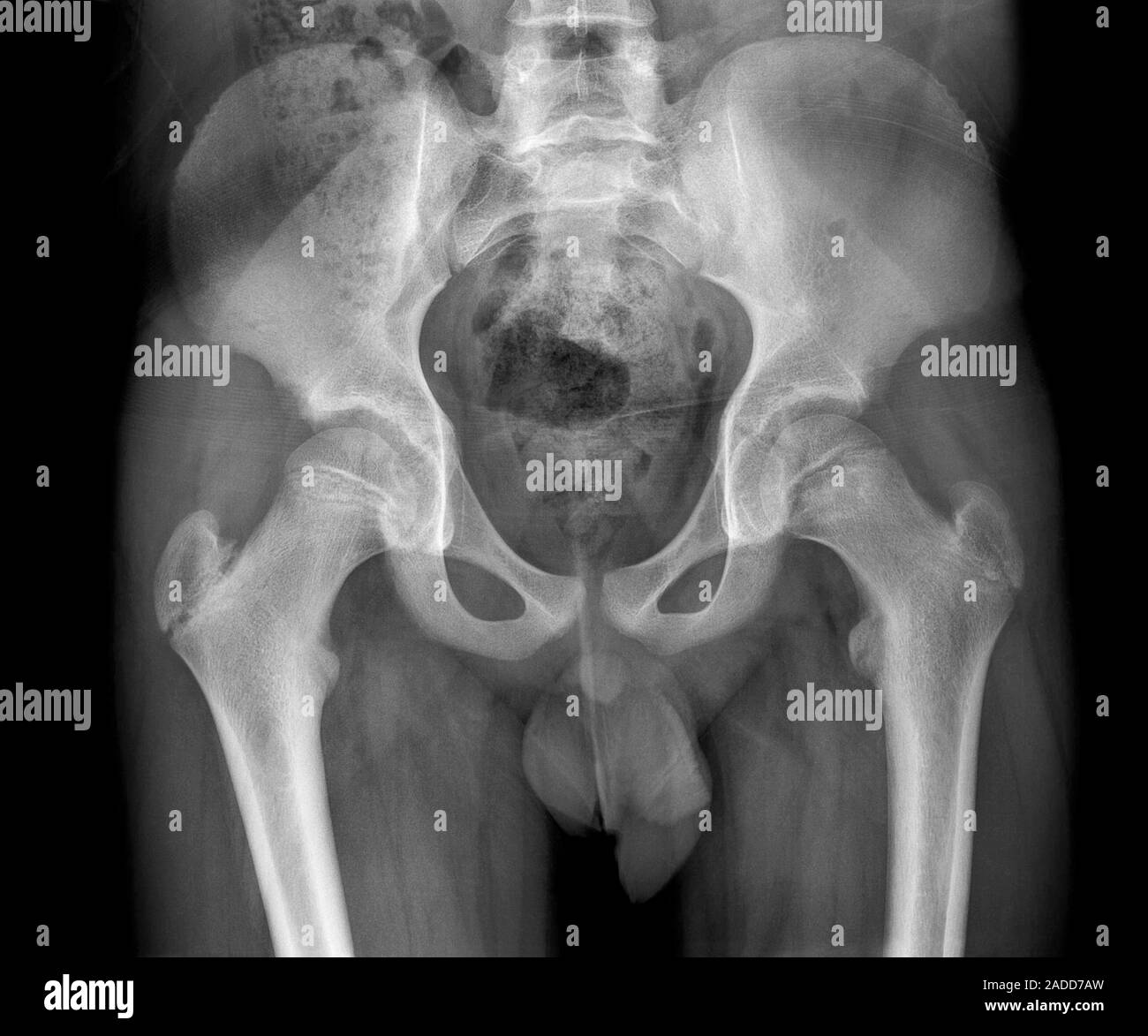 Slipped capital femoral epiphysis. Frontal X-ray of a patient's hip ...