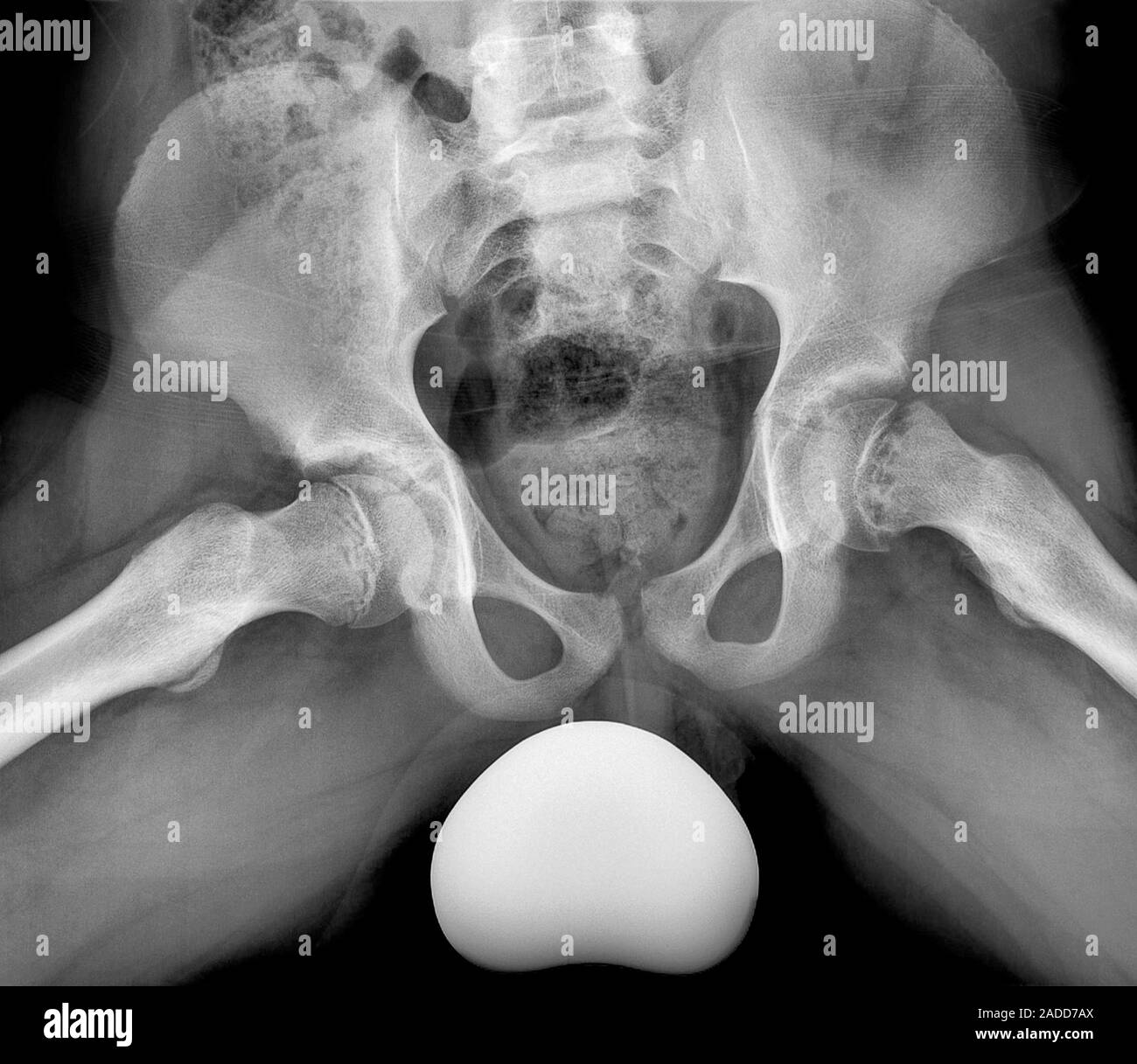 Slipped capital femoral epiphysis. Frontal X-ray of a patient's hip ...