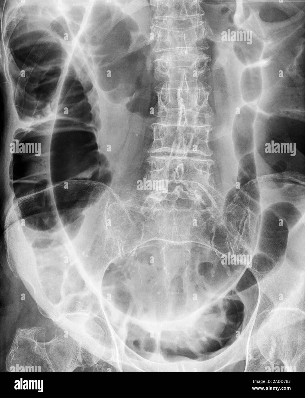 Twisted colon. X-ray of the abdomen of a patient with a twisted sigmoid ...