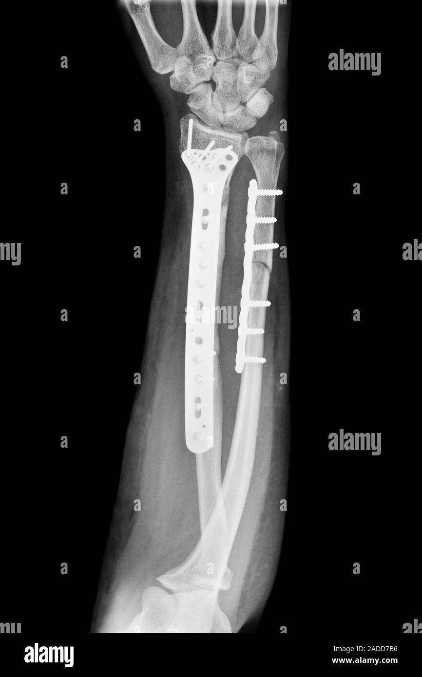 Pinned fractured lower arm bones, X-ray. These fractures of the ulna ...