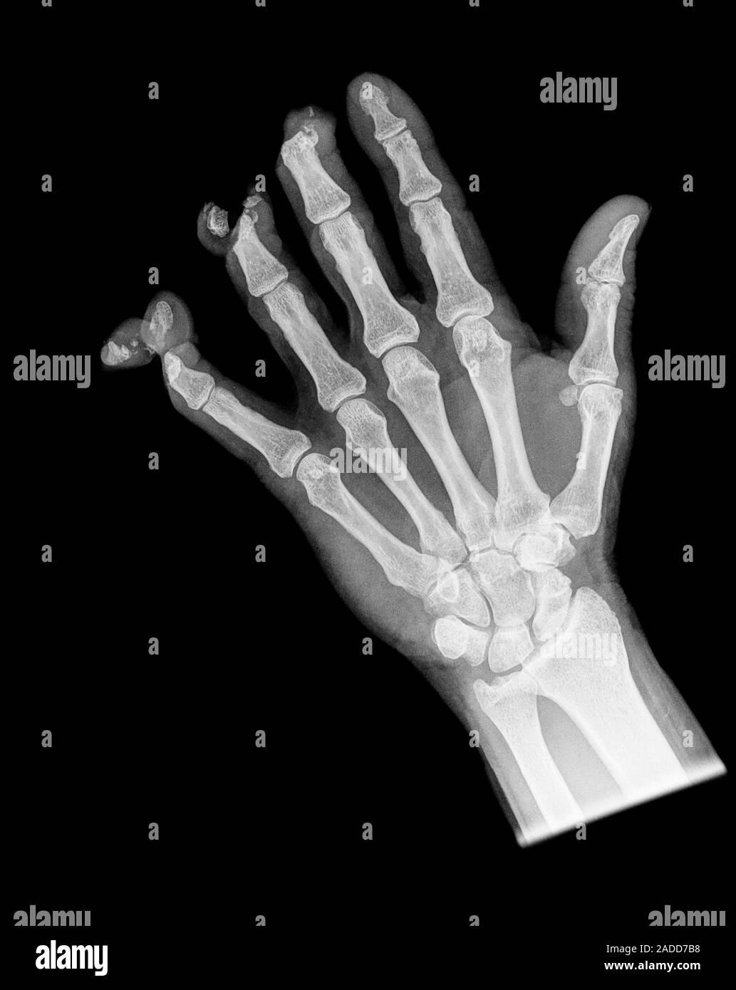 Lawnmower finger injuries, X-ray. Surgery will be required to repair ...