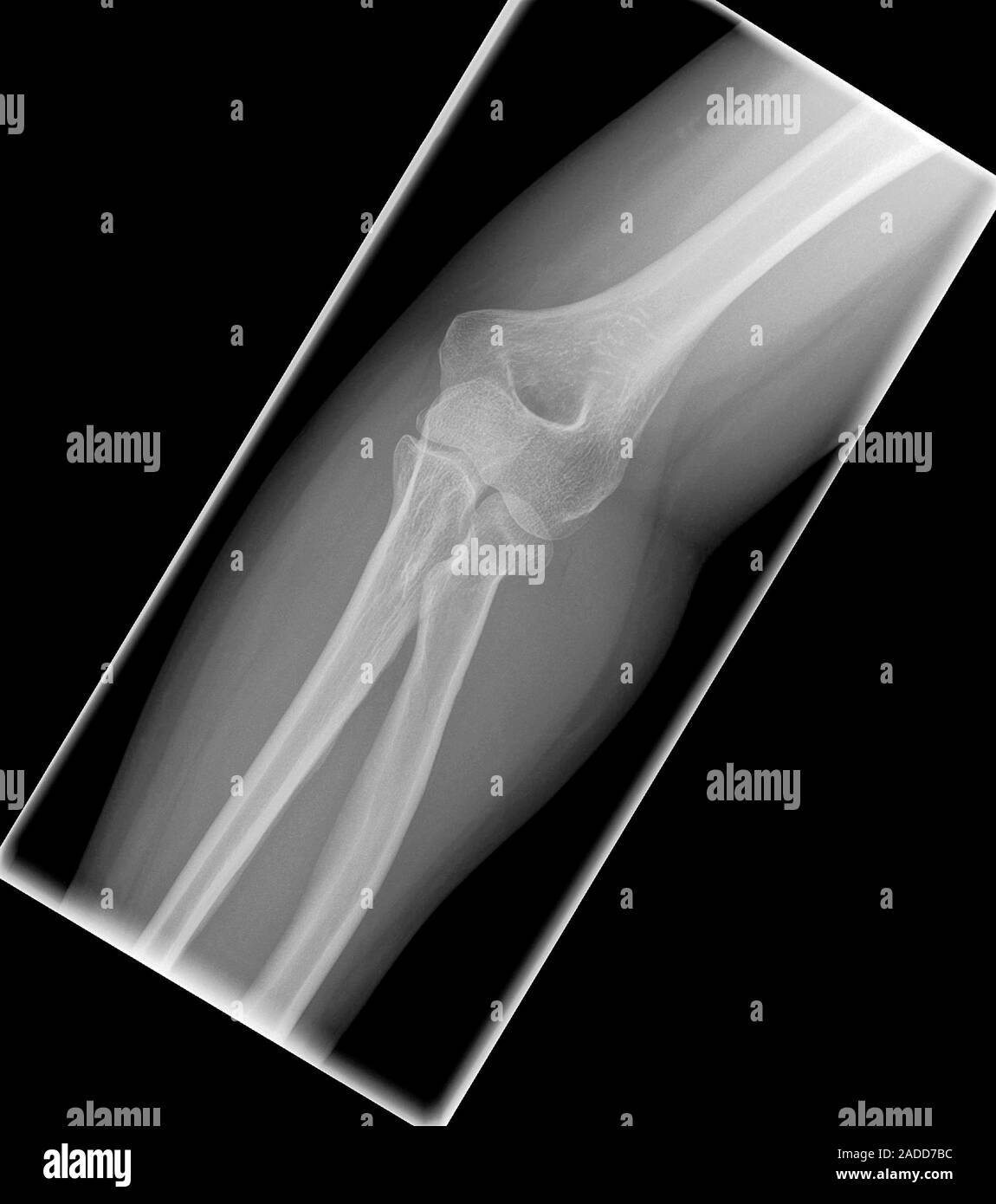 Fracture of elbow bone, X-ray. This fracture is of the head of the ...
