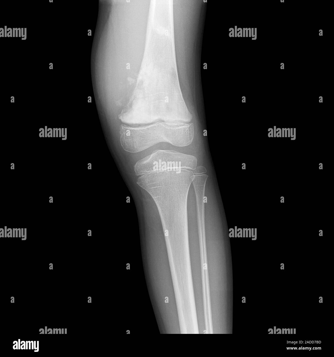 Bone cancer of the leg, X-ray. This cancer (osteosarcoma) has affected ...