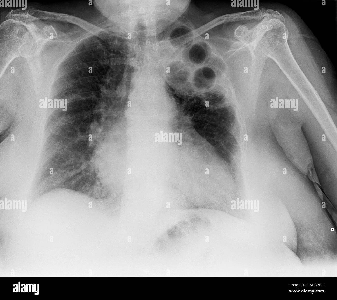 Plombage tuberculosis treatment. X-ray of the lungs of a patient who ...
