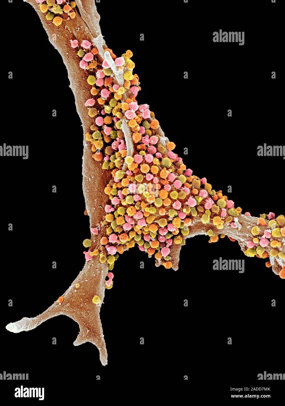 Cell infected with herpes virus. Coloured scanning electron micrograph ... Cell infected with herpes virus. Coloured scanning electron micrograph ...