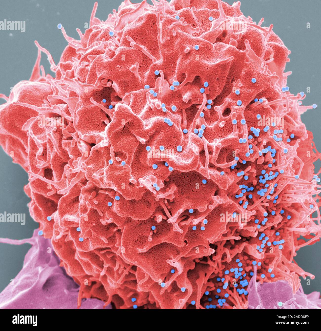 HIV infected 293T cell. Coloured scanning electron micrograph (SEM) of ...