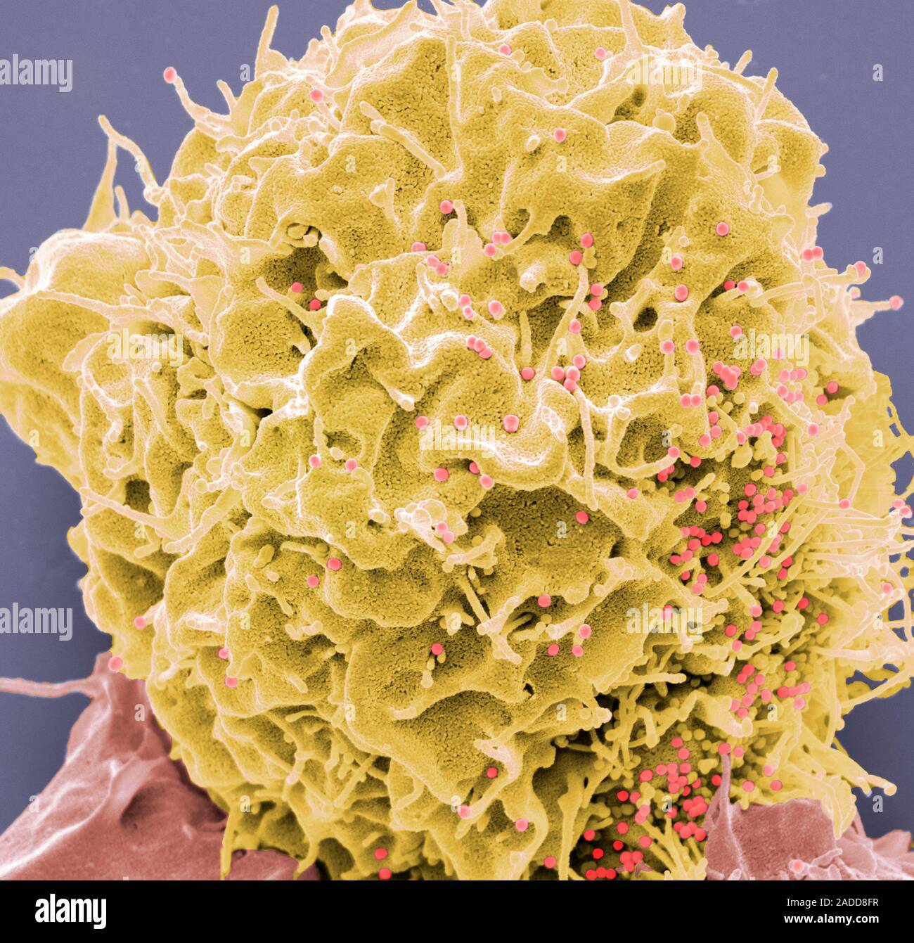 HIV infected 293T cell. Coloured scanning electron micrograph (SEM) of ...