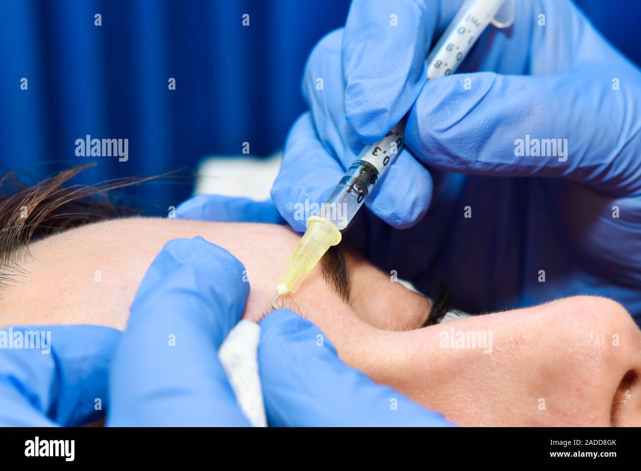 Botox injection. Patient having botox injected into their forehead ...