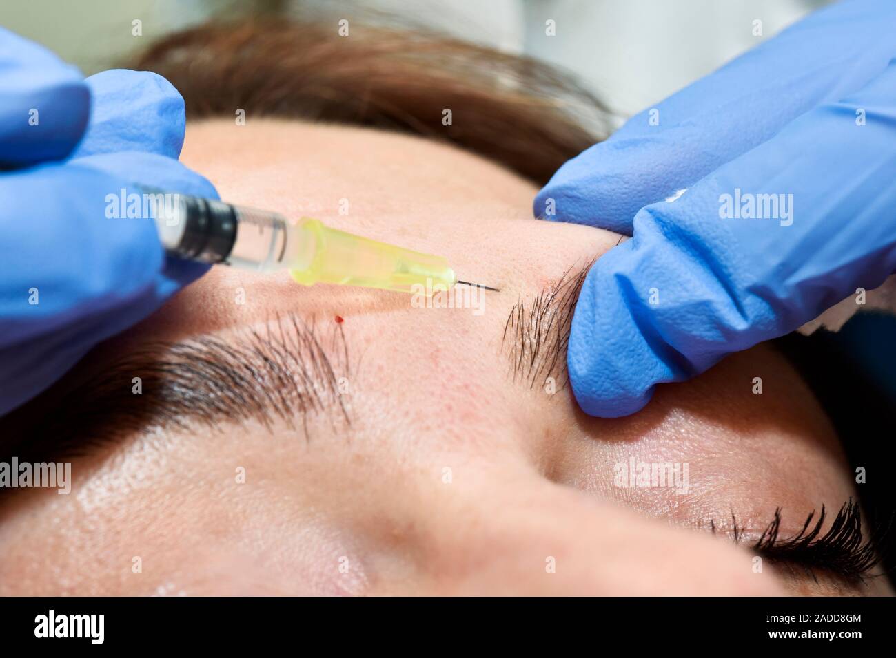 Botox injection. Patient having botox injected into their forehead ...