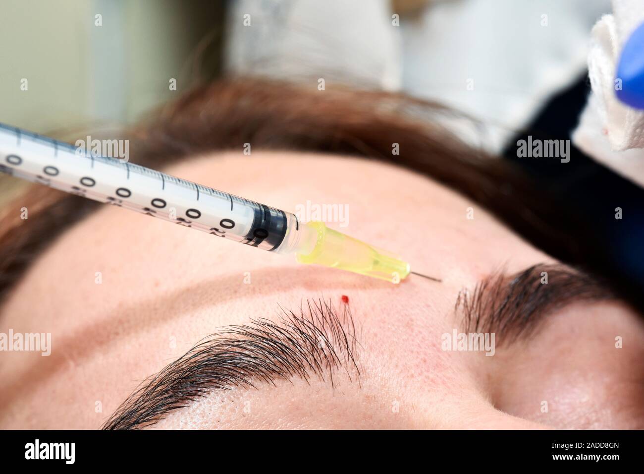 Botox injection. Patient having botox injected into their forehead ...