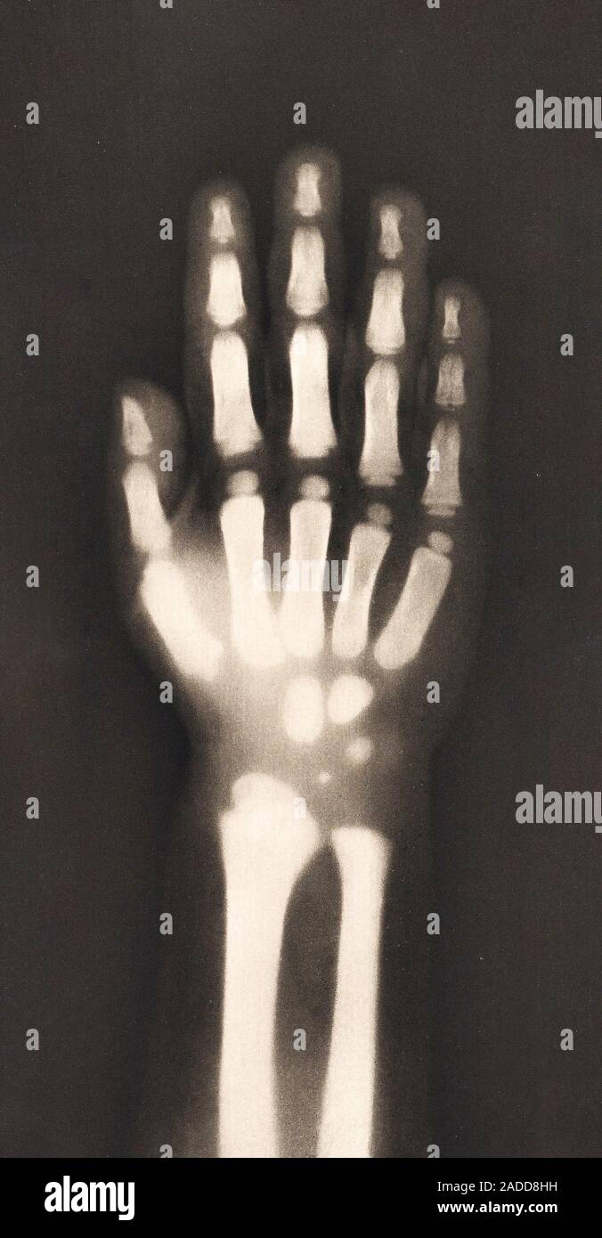 X-ray of a child's hand. X-ray photogravure of the bones of a 4-year ...