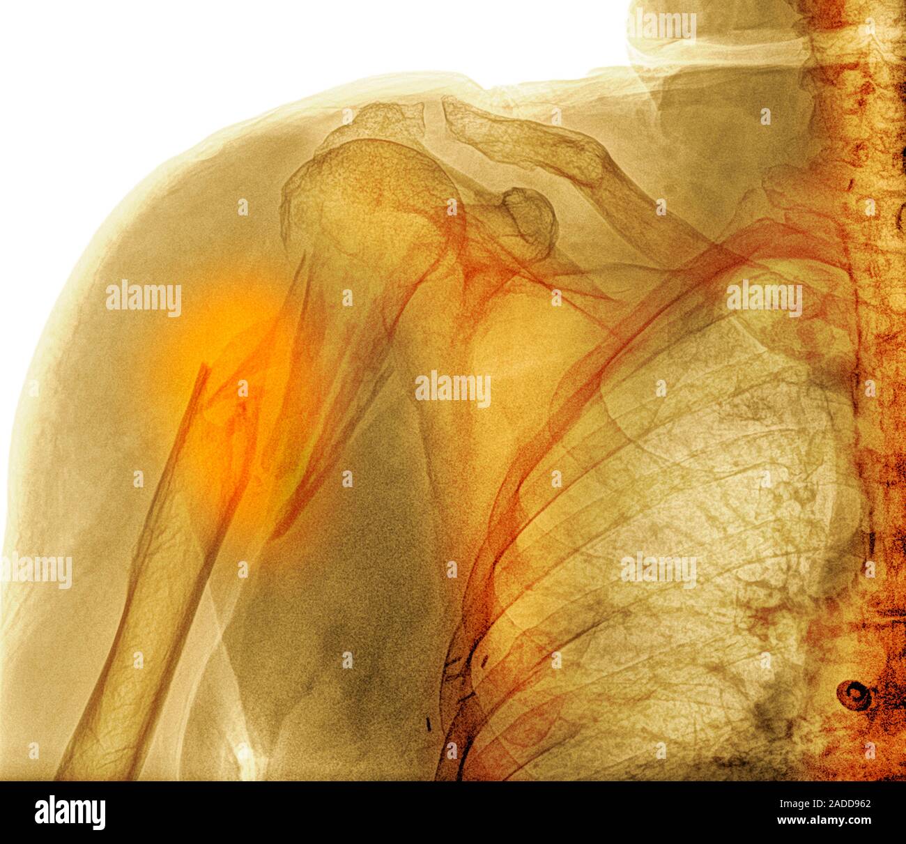 Broken upper arm bone. Coloured frontal X-ray of the fractured right ...