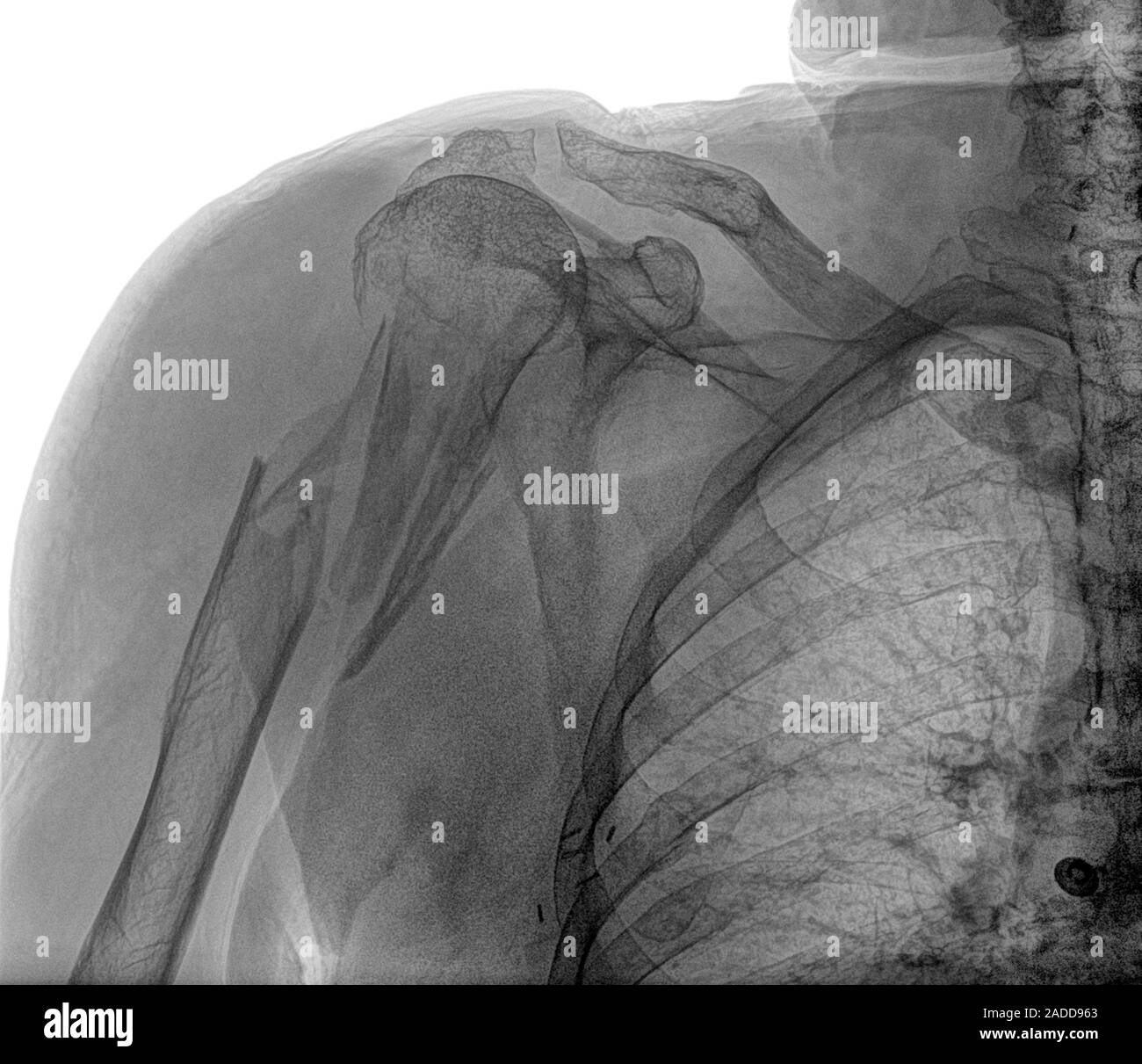 Broken upper arm bone. Frontal X-ray of the fractured right humerus ...