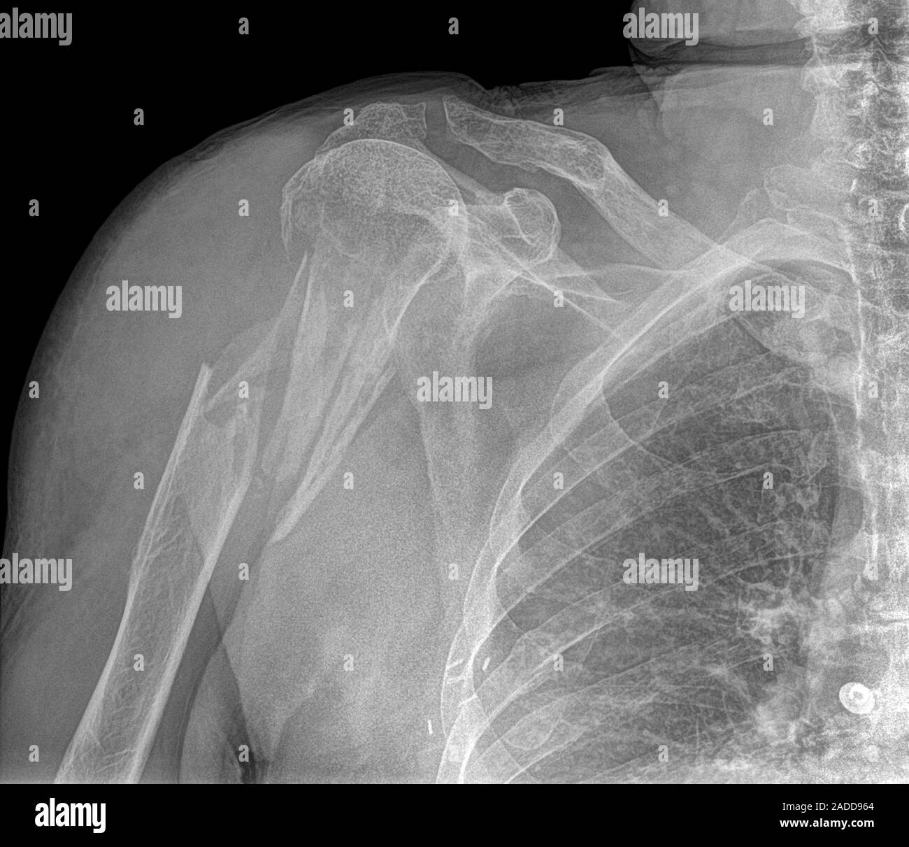 Broken upper arm bone. Frontal X-ray of the fractured right humerus ...